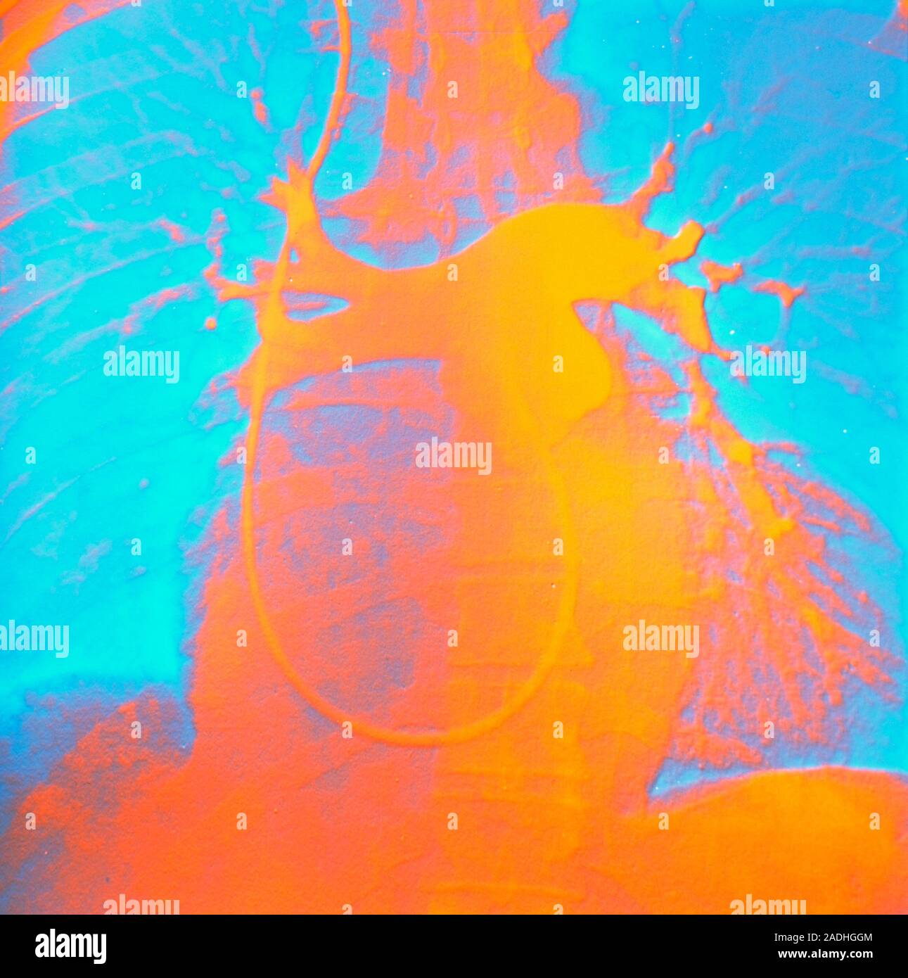 Angiogramme en fausses couleurs d'une personne avec une hypertrophie du ...