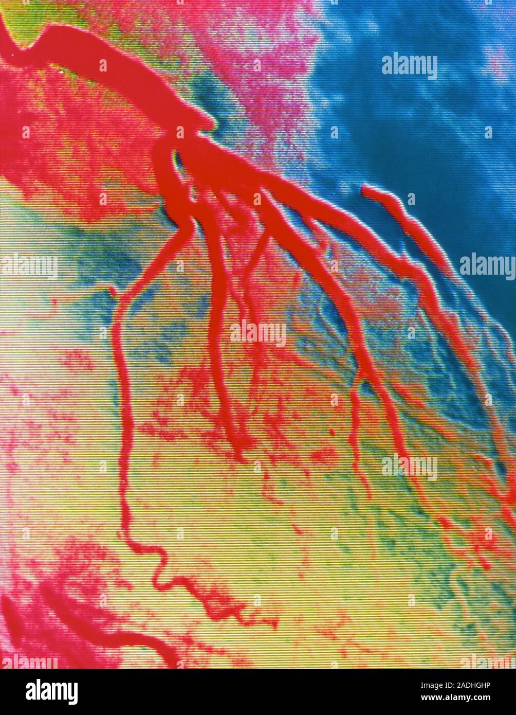 Angiogramme en fausses couleurs (artériographie) d'un cœur humain ...