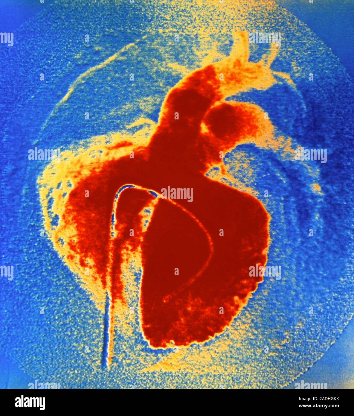 Les maladies cardiaques congénitales (trou dans le coeur). Un ...