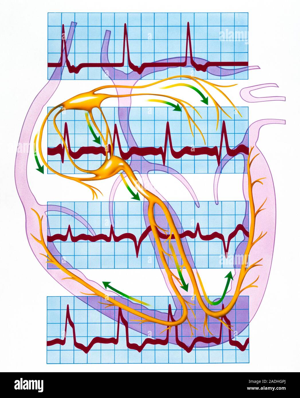 L'arythmie cardiaque. Illustration d'un article par le biais d'un cœur ...