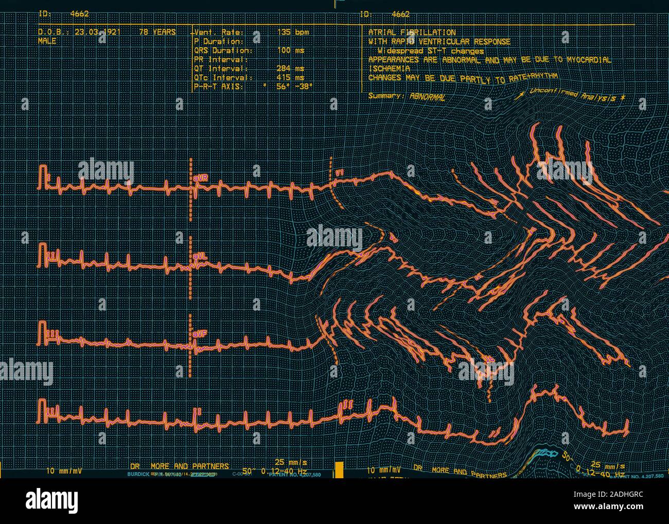 La maladie de coeur. Électrocardiogramme (ECG) déformée des traces ...