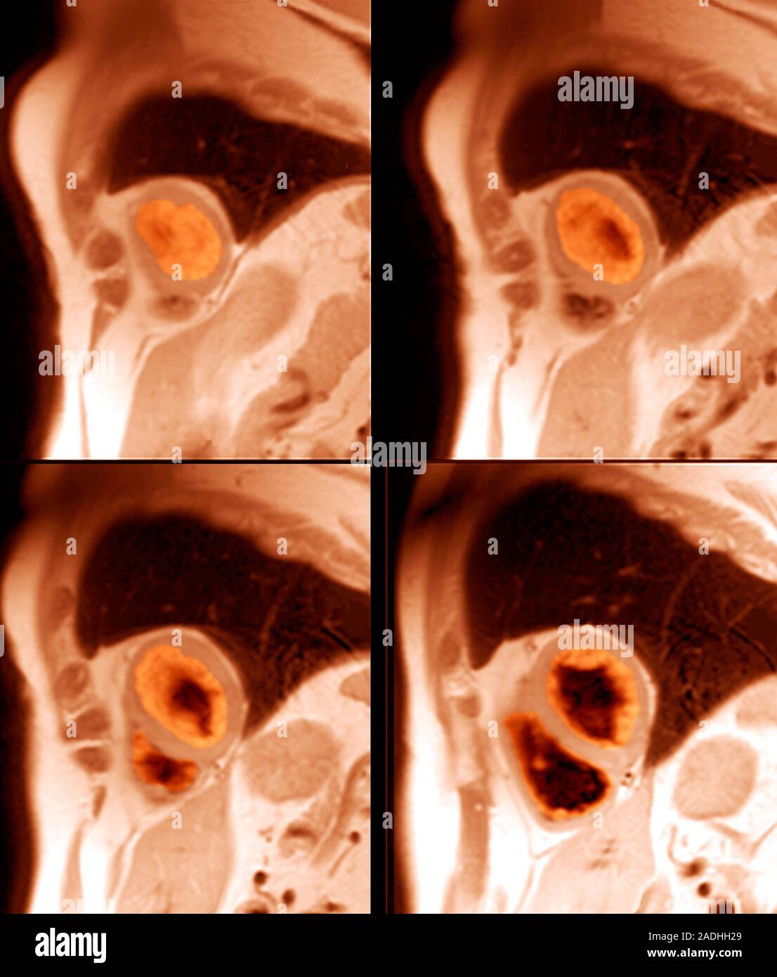 Caillot de sang dans le cœur. Couleur de la séquence d'imagerie par ...