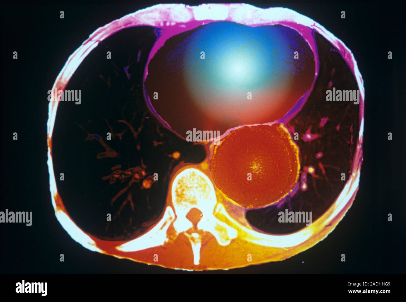 Anévrisme aortique. Couleur scanner d'un anévrisme de l'aorte ...