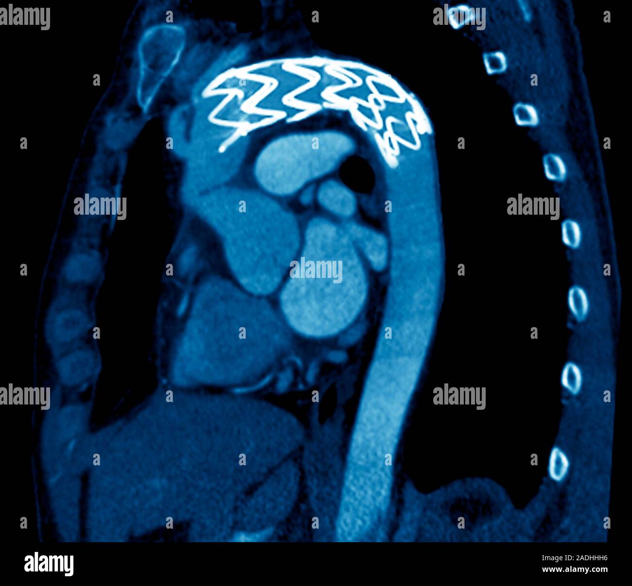 Stent dans une dissection de l'aorte. Sagittale couleur scanner de l ...