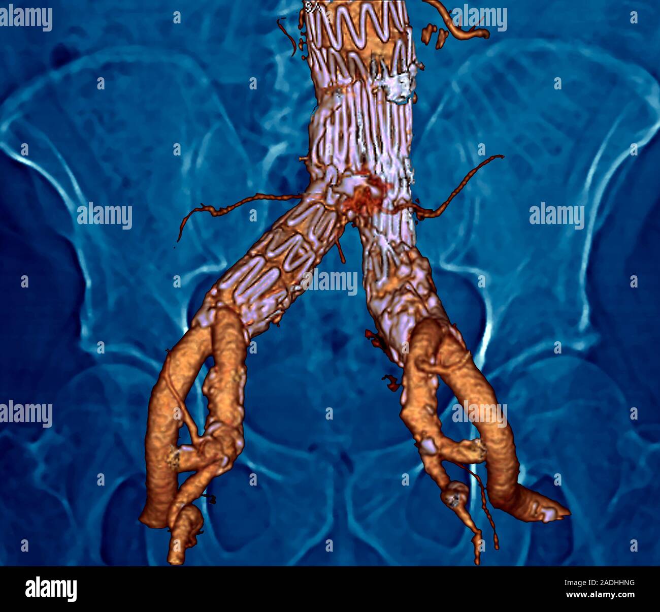 Stent dans l'aorte abdominale. 3D couleur scanner d'un stent dans l ...