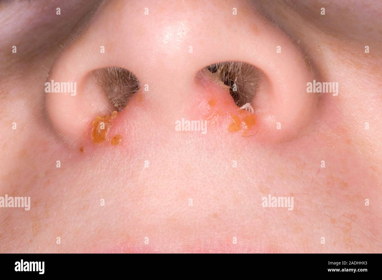 L'impétigo infection (orange) sur un garçon de 14 ans. L'impétigo est ...