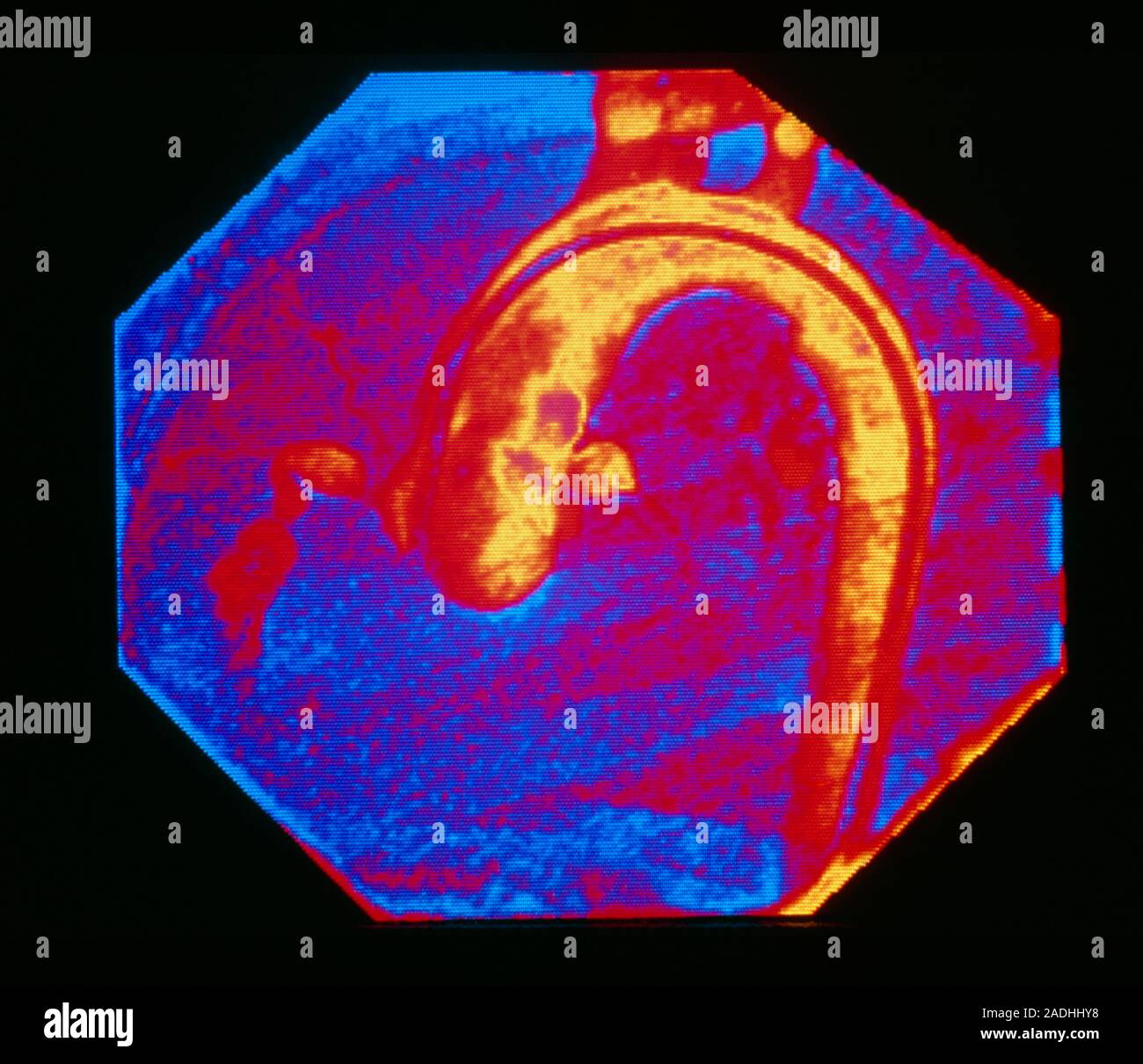 La maladie de Kawasaki. Angiogramme de couleur (X-ray) d'anomalies des ...