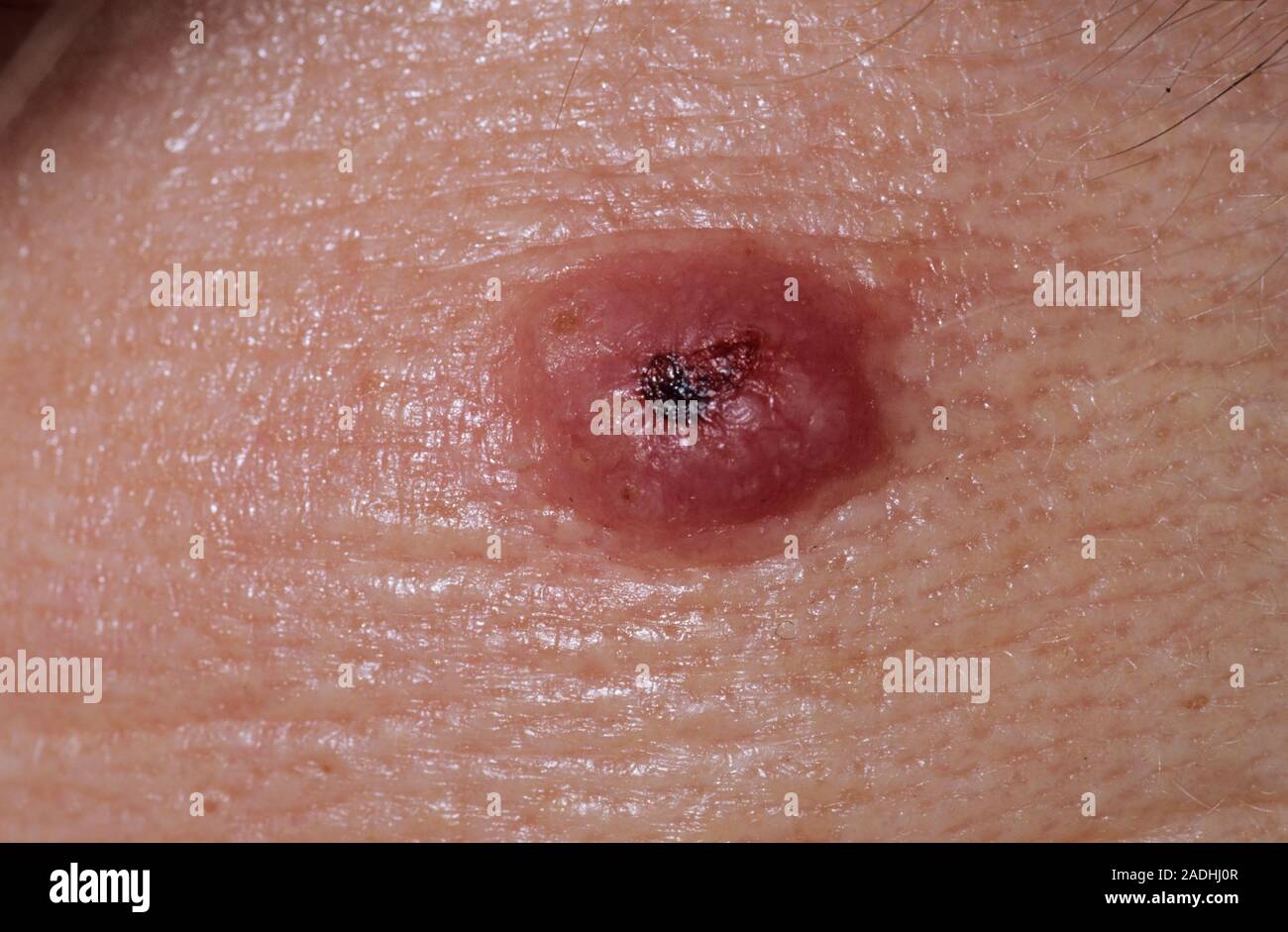 Keratoacanthoma sur le front d'une femme de 77 ans. Il s'agit d'un ...