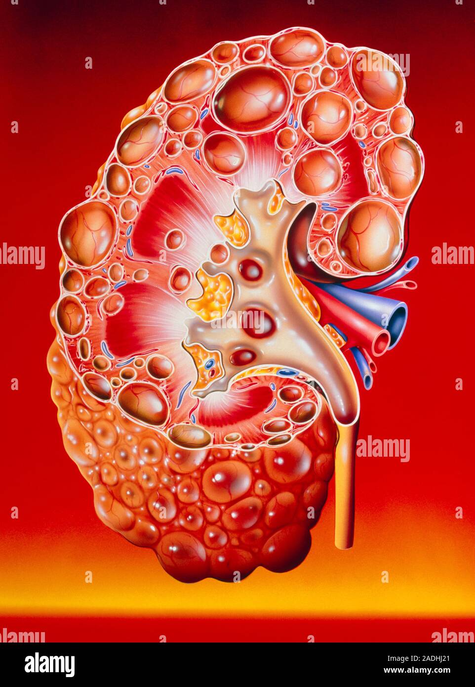 Illustration d'une polykystose rénale humaine. La polykystose rénale ...