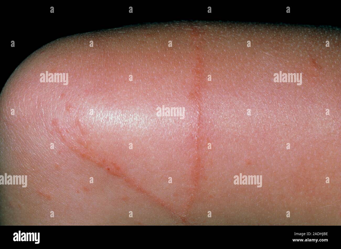 Larva migrans cutanée. Des éruptions rouges linéaire autour d'un genou ...