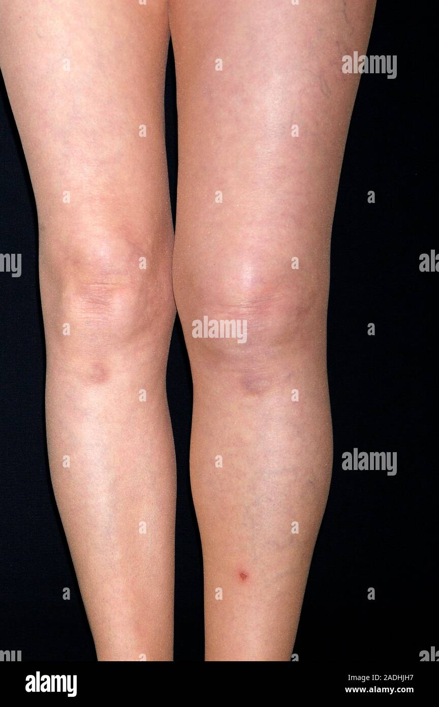 Jambe gonflée à cause du cancer. Enflure des jambes (droite) d'une ...