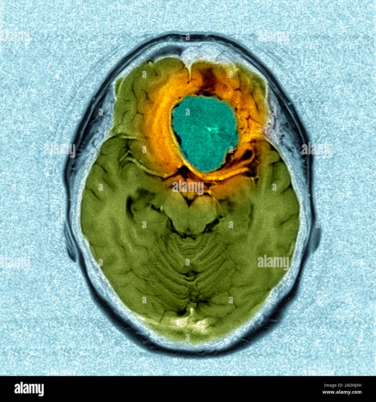 Tumeur au cerveau. L'imagerie par résonance magnétique de couleur (IRM) d'un jeu axial ...