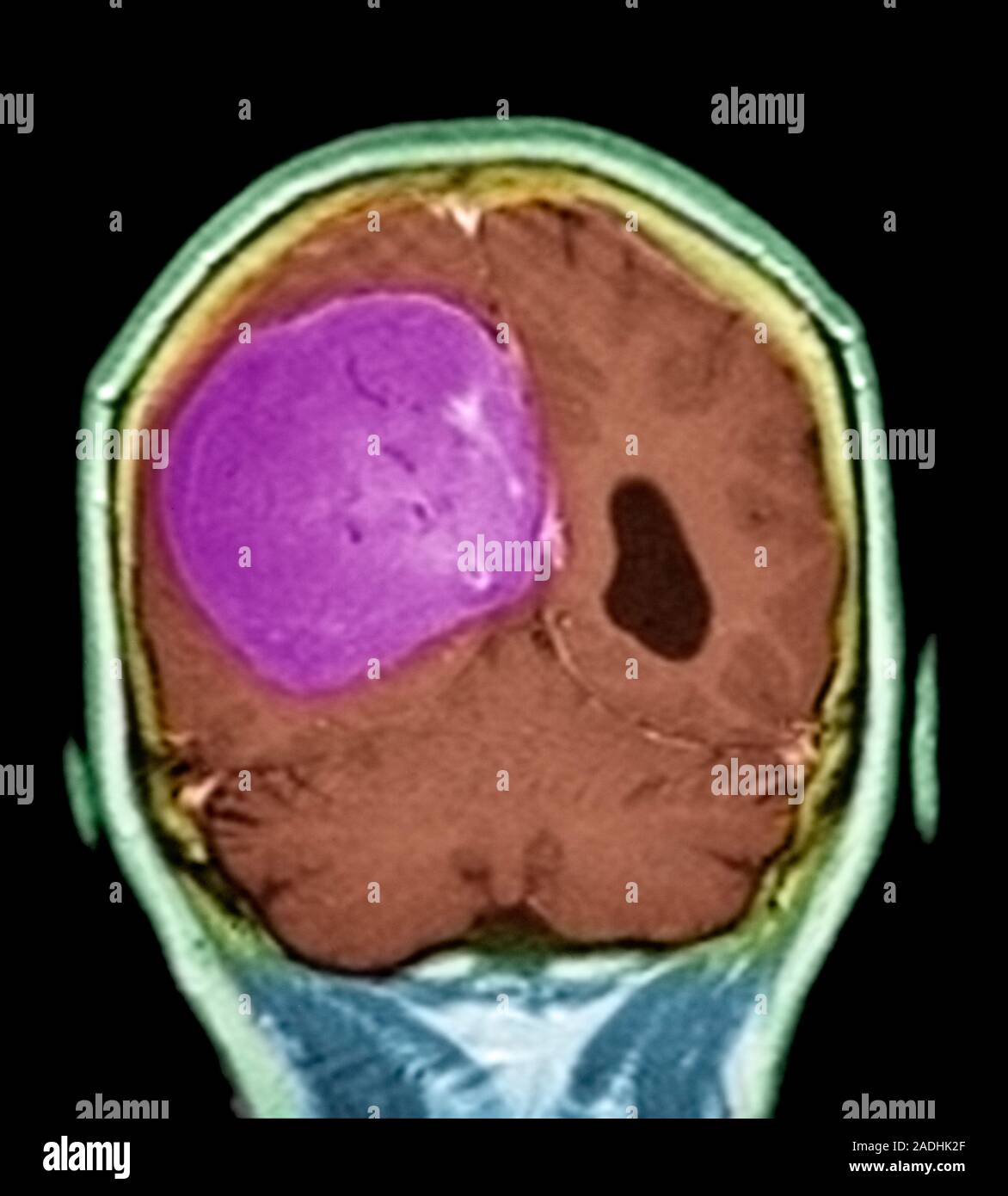 Méningiome tumeur au cerveau. L'imagerie par résonance magnétique de couleur (IRM) de la tête d ...
