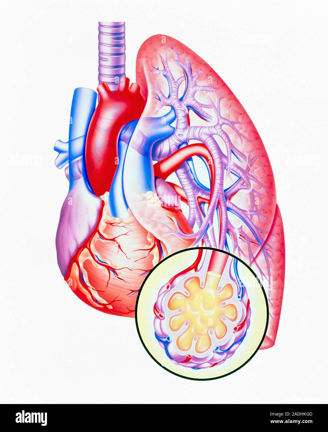 Oedème pulmonaire dans l'insuffisance cardiaque. Illustration montrant ...