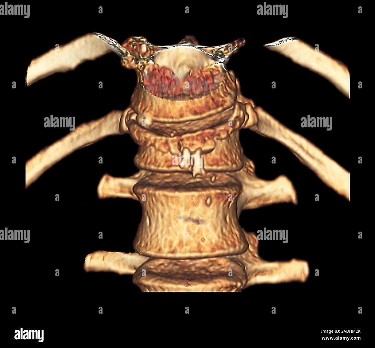 Fracture de la colonne vertébrale ostéoporotique. 3D couleur Scanner ...