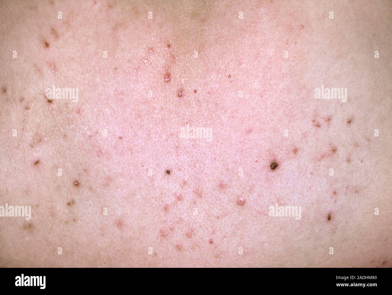 Pityriasis Lichenoides. Des taches rouge foncé sur la peau d'un 75-year ...