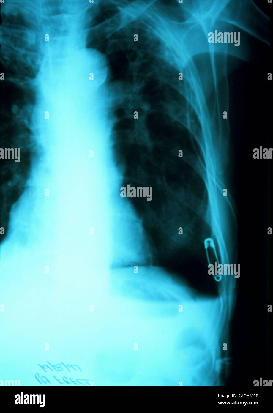Traitement d'un pneumothorax. Poitrine de couleur X-ray montrant un ...