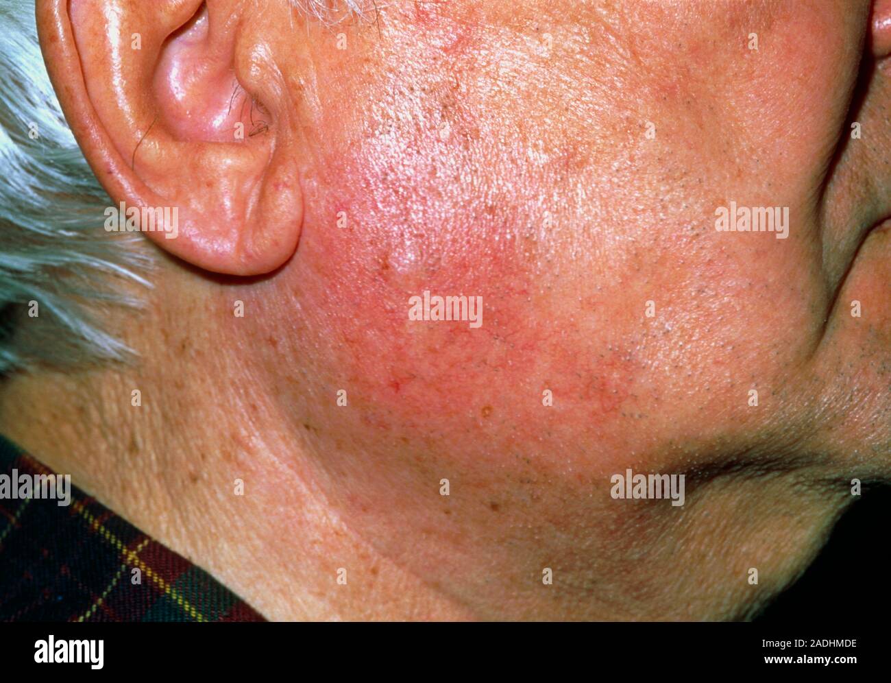 L'inflammation de la glande parotide dans la joue d'un 78 ans, homme ...