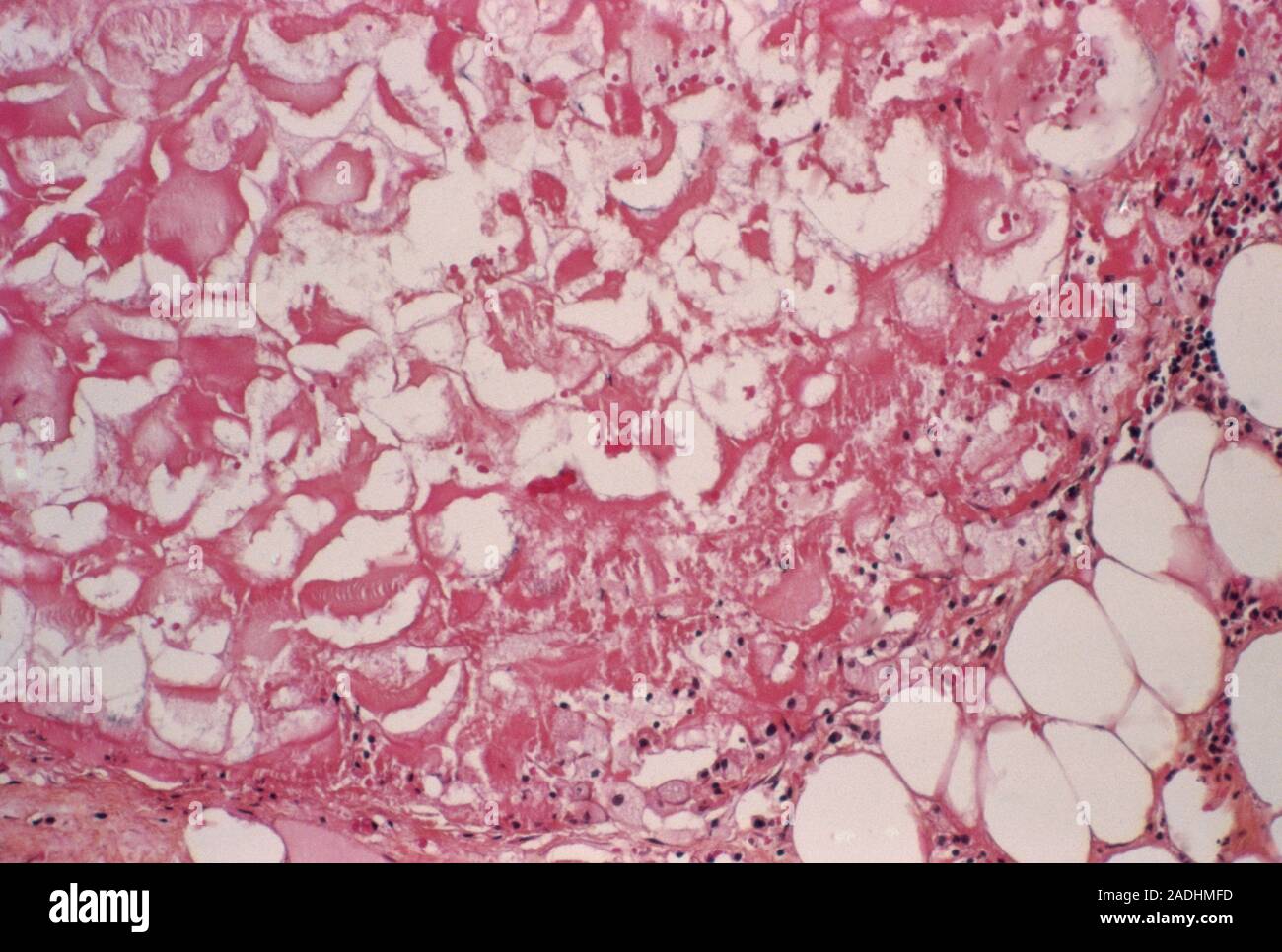 La nécrose de la graisse de pancréas. Micrograph Light d'une section ...