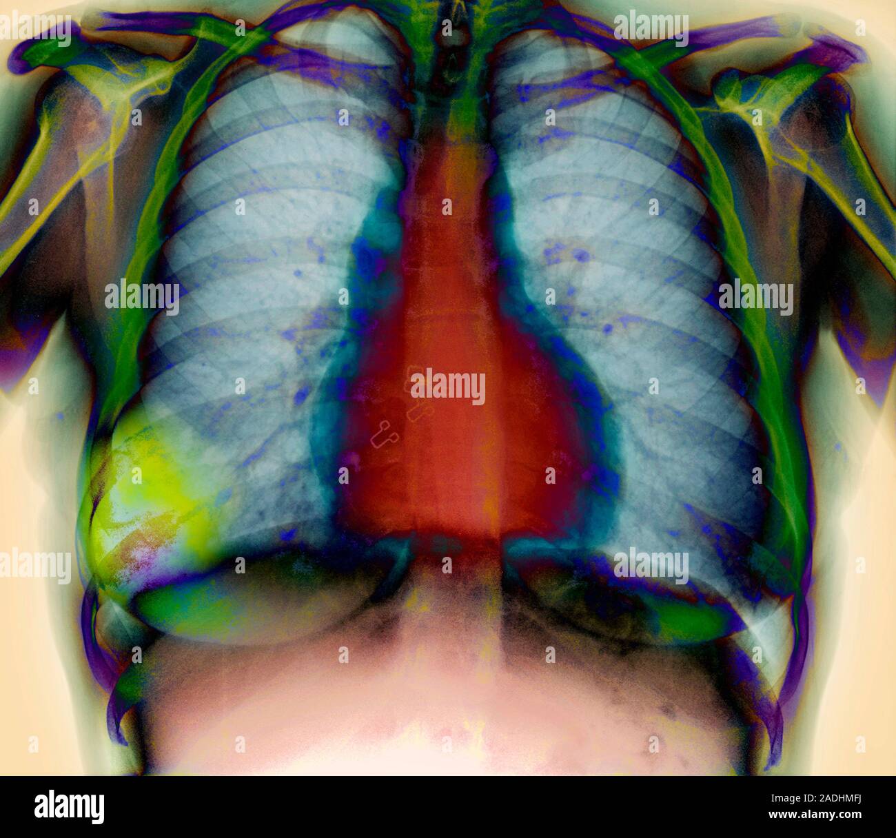 La pneumonie. Radiographie de la couleur d'une pneumonie (infection ...