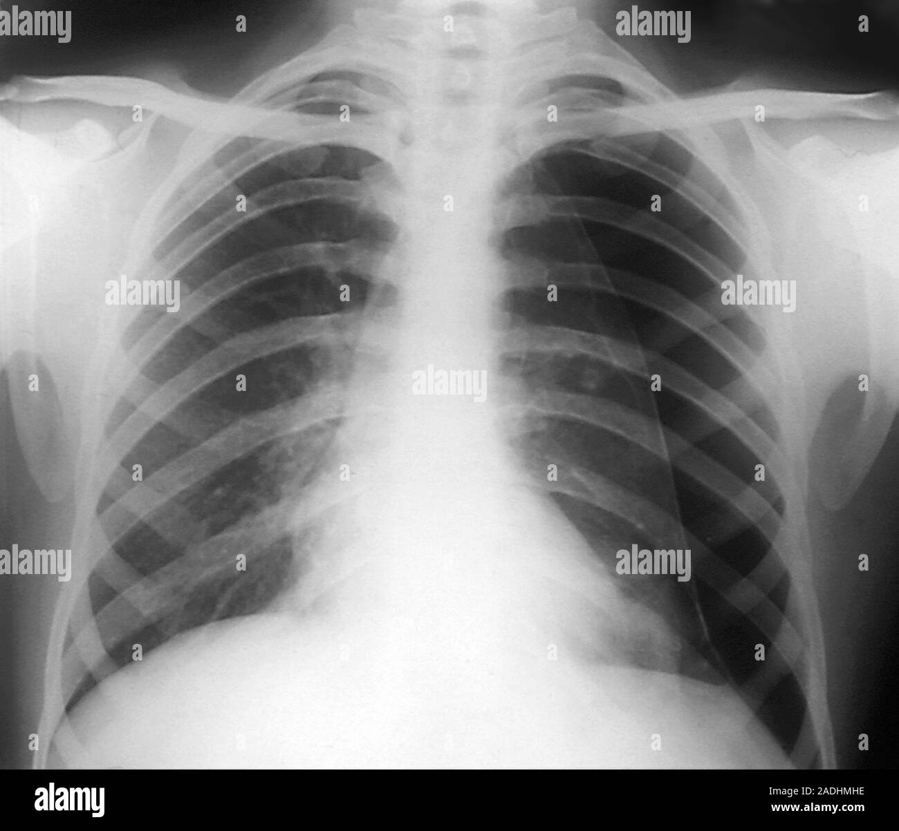 Pneumothorax. Radiographie de la frontale d'un patient atteint d'un ...