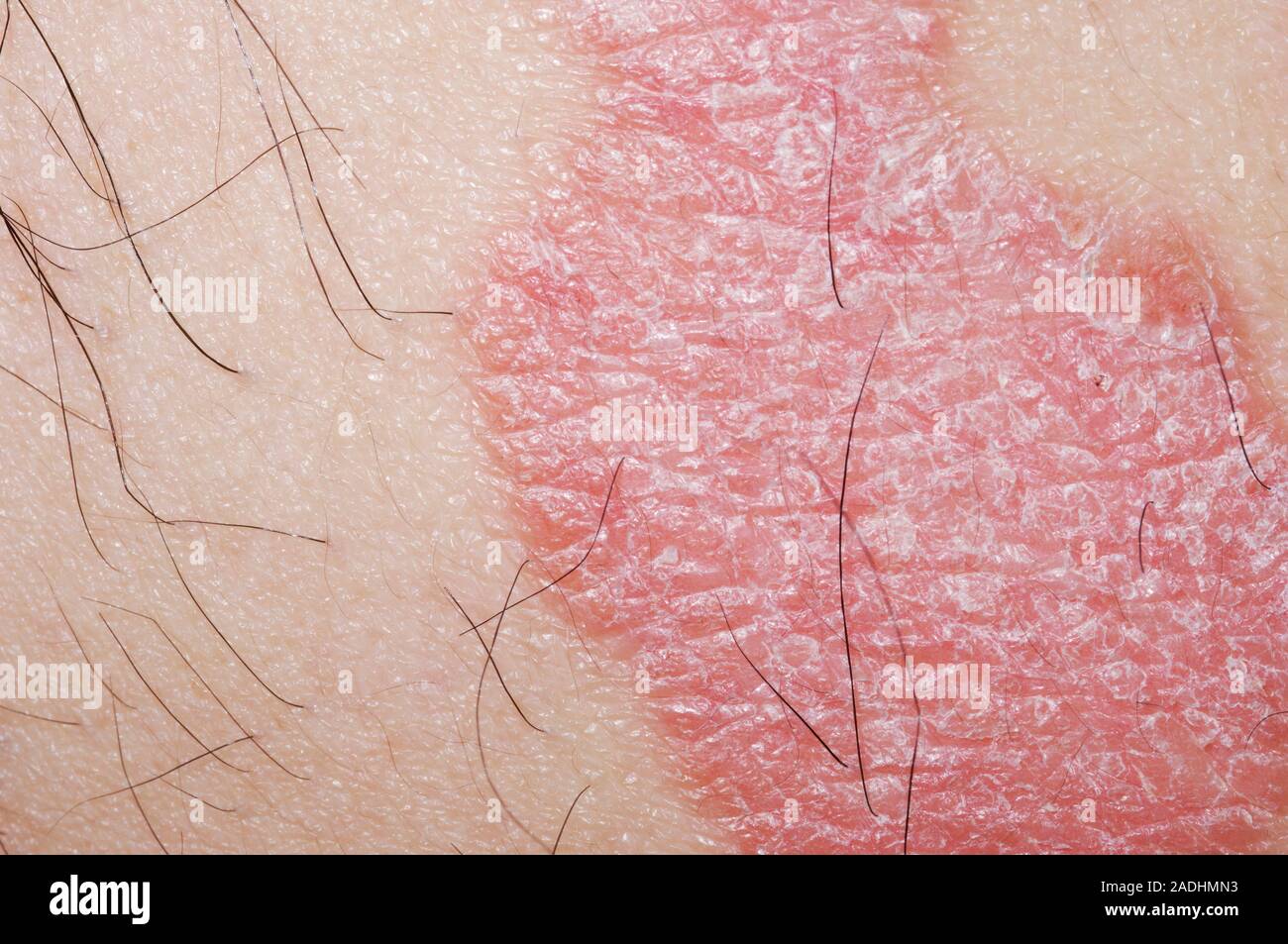 Psoriasis rash sur l'abdomen de l'homme de 44 ans. Le psoriasis est une ...