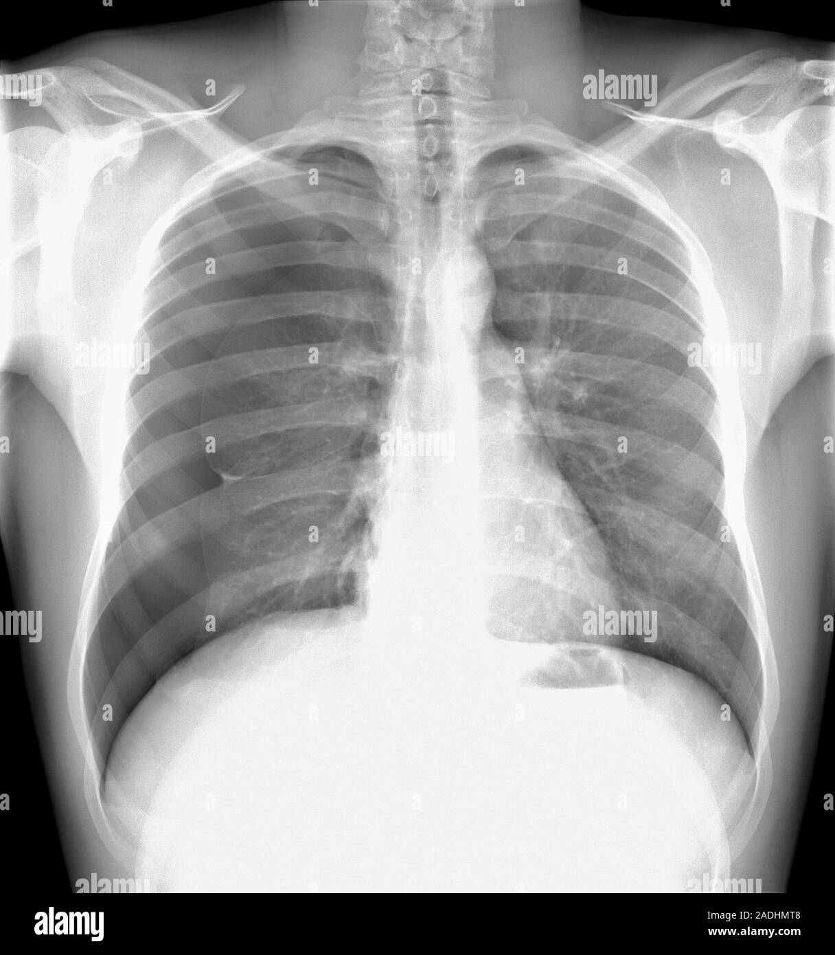 Pneumothorax. X-ray de la poitrine d'un patient atteint d'un ...