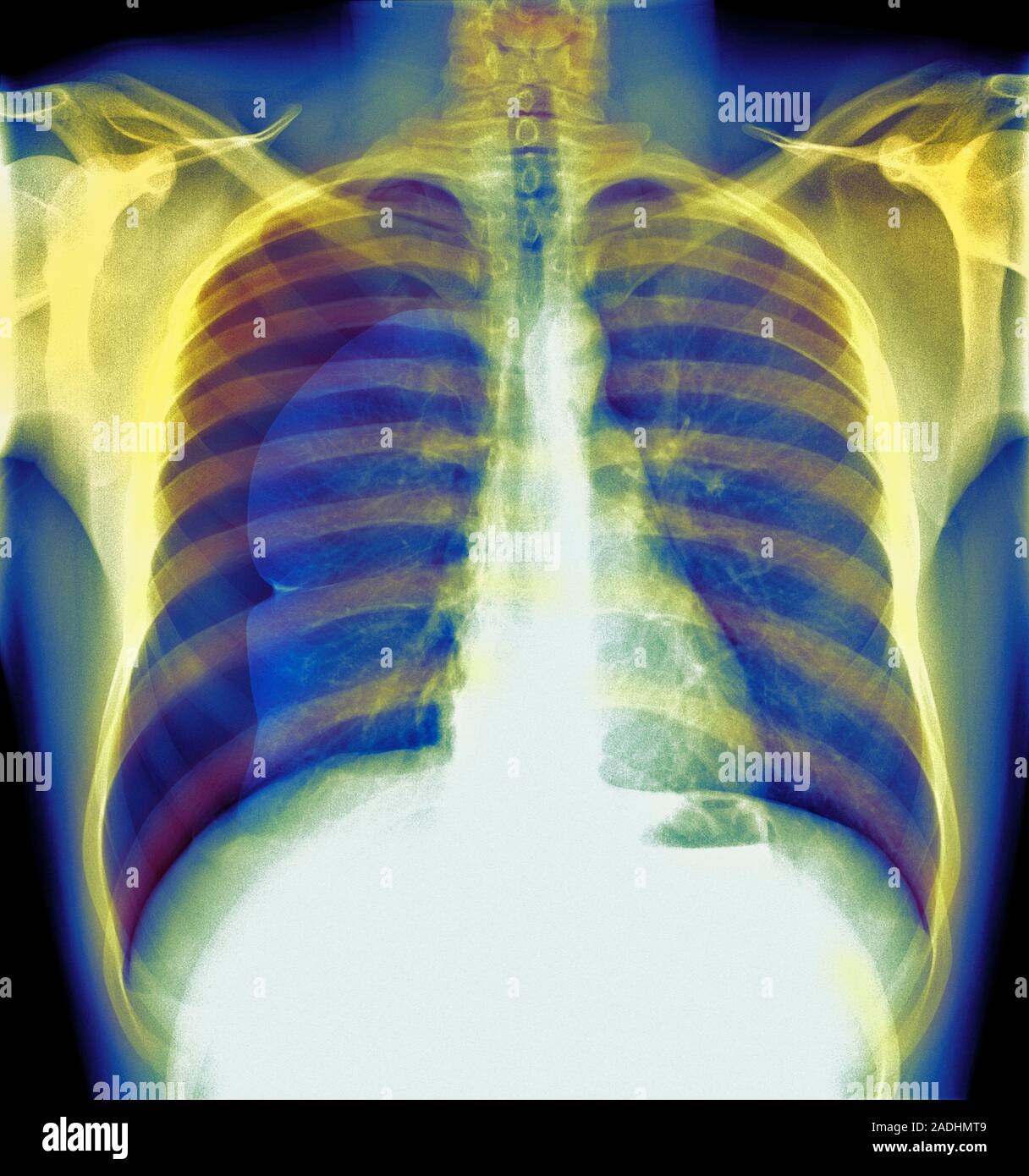 Pneumothorax. X-ray de couleur de la poitrine d'un patient atteint d'un ...