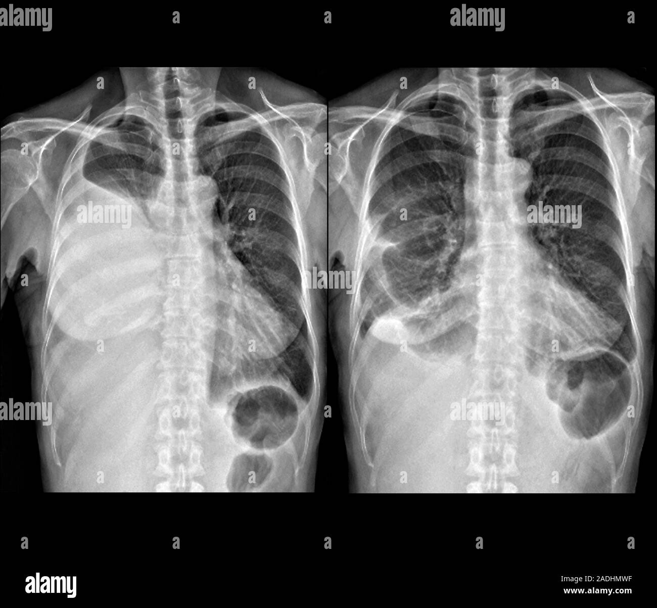 Une pleurésie. La radiographie des poumons d'un patient âgé de 65 ans ...