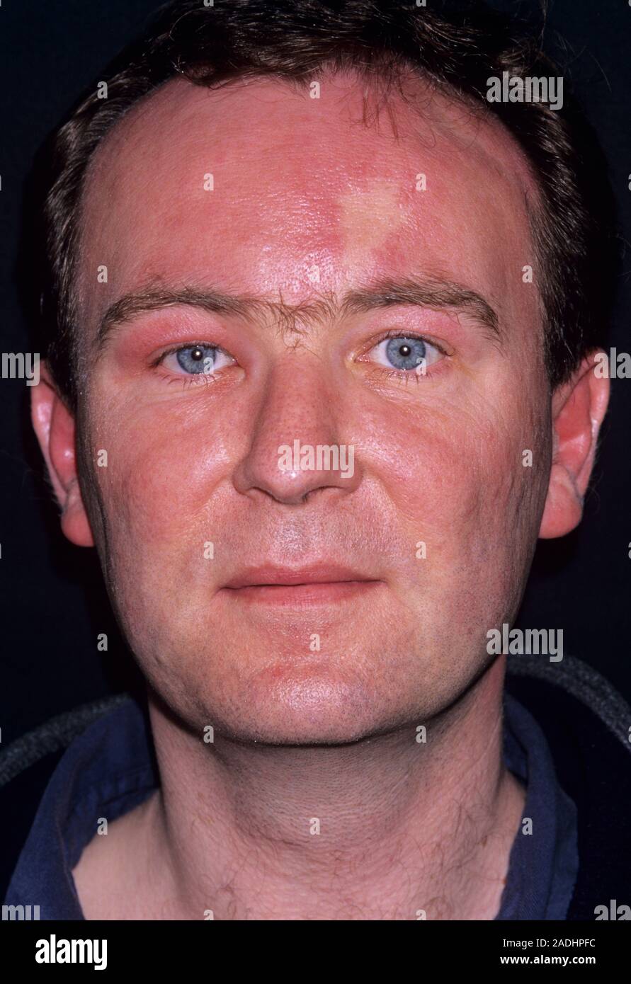 Éruption cutanée sur le visage d'un 39-year-old man presenting avec la ...