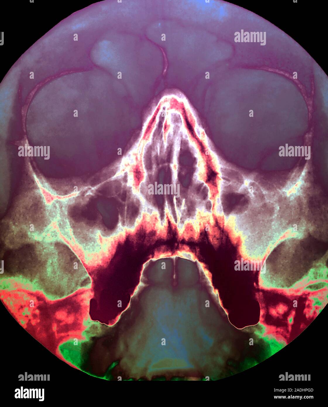 La sinusite. X-ray de couleur du visage d'un patient avec une sinusite ...