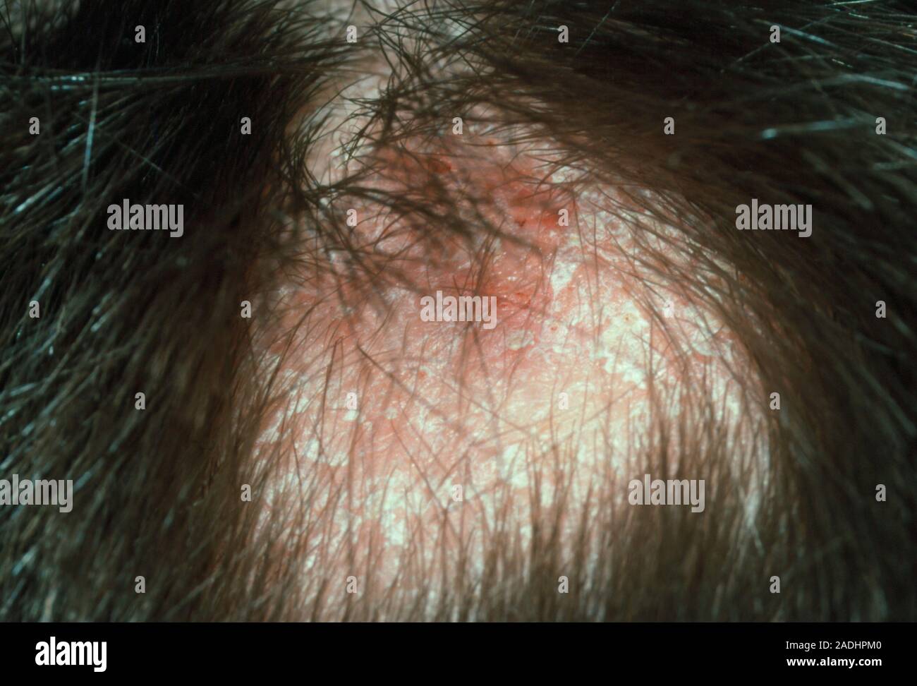 Le tinea capitis. Close-up of a la teigne lésion sur le cuir chevelu ...