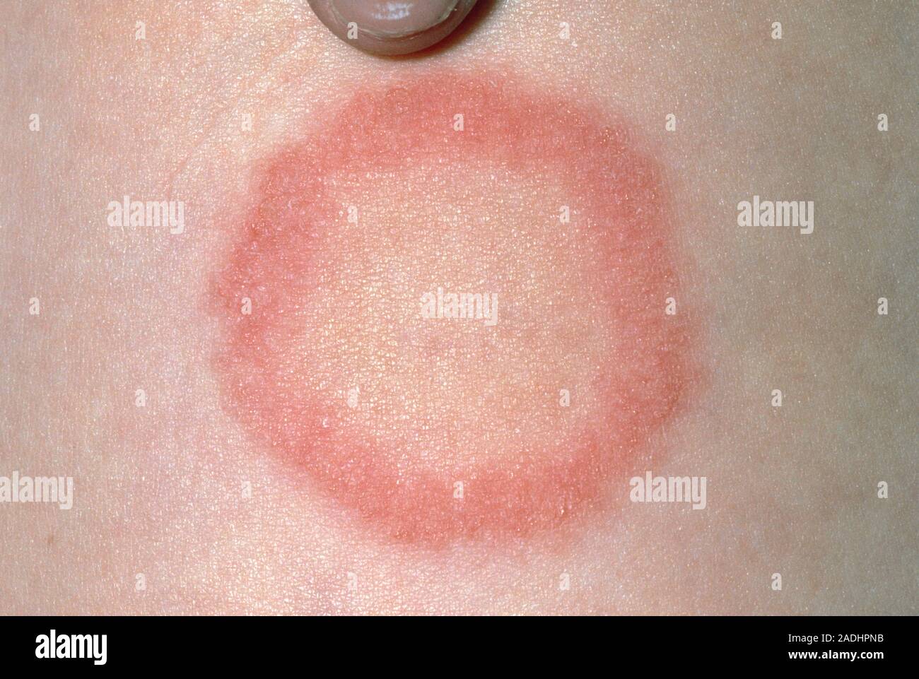 La teigne sur la jambe. Close-up d'une circulaire classique la teigne ...