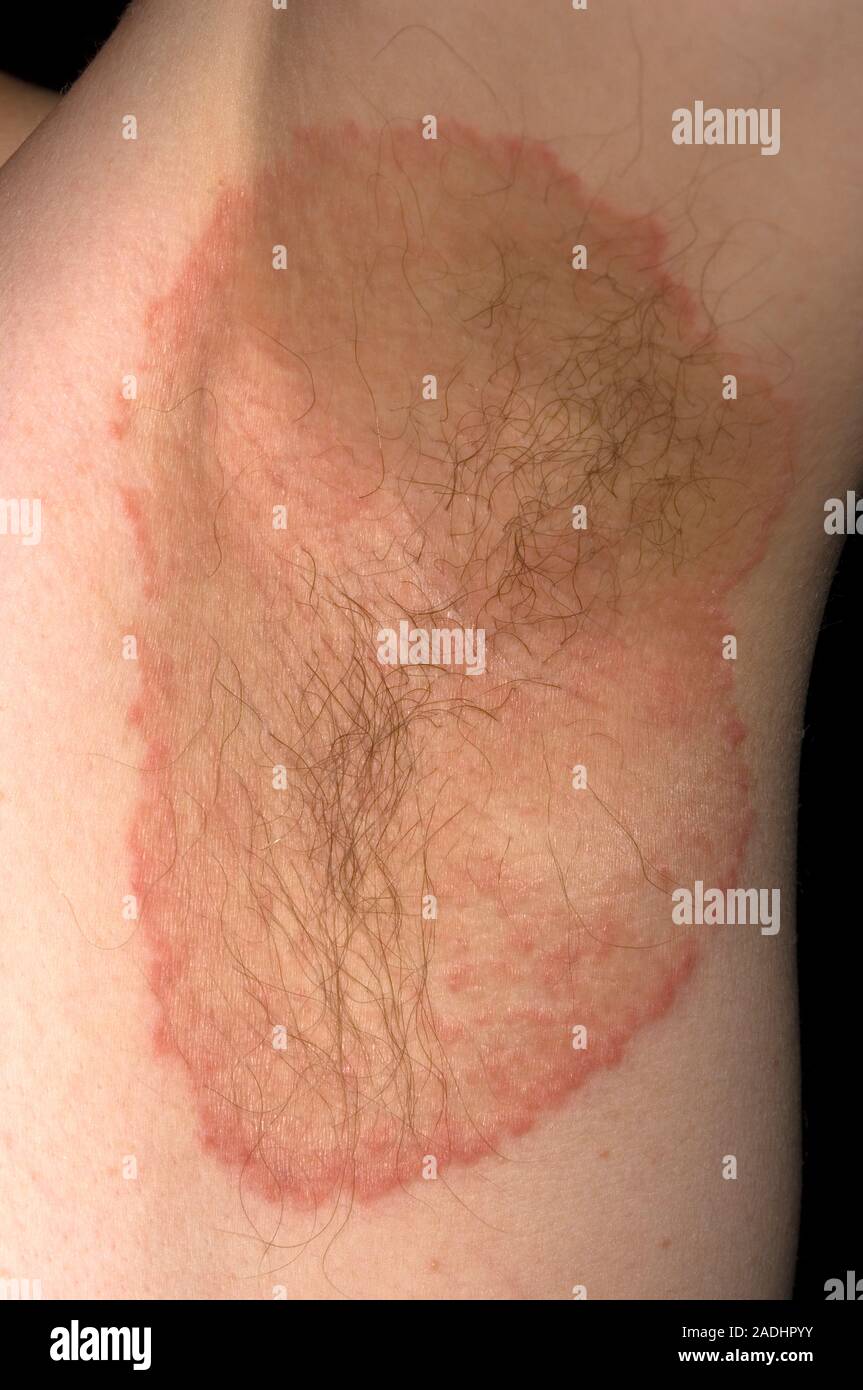 La Teigne (tinea infection) dans un homme de 52 ans l'aisselle. La ...