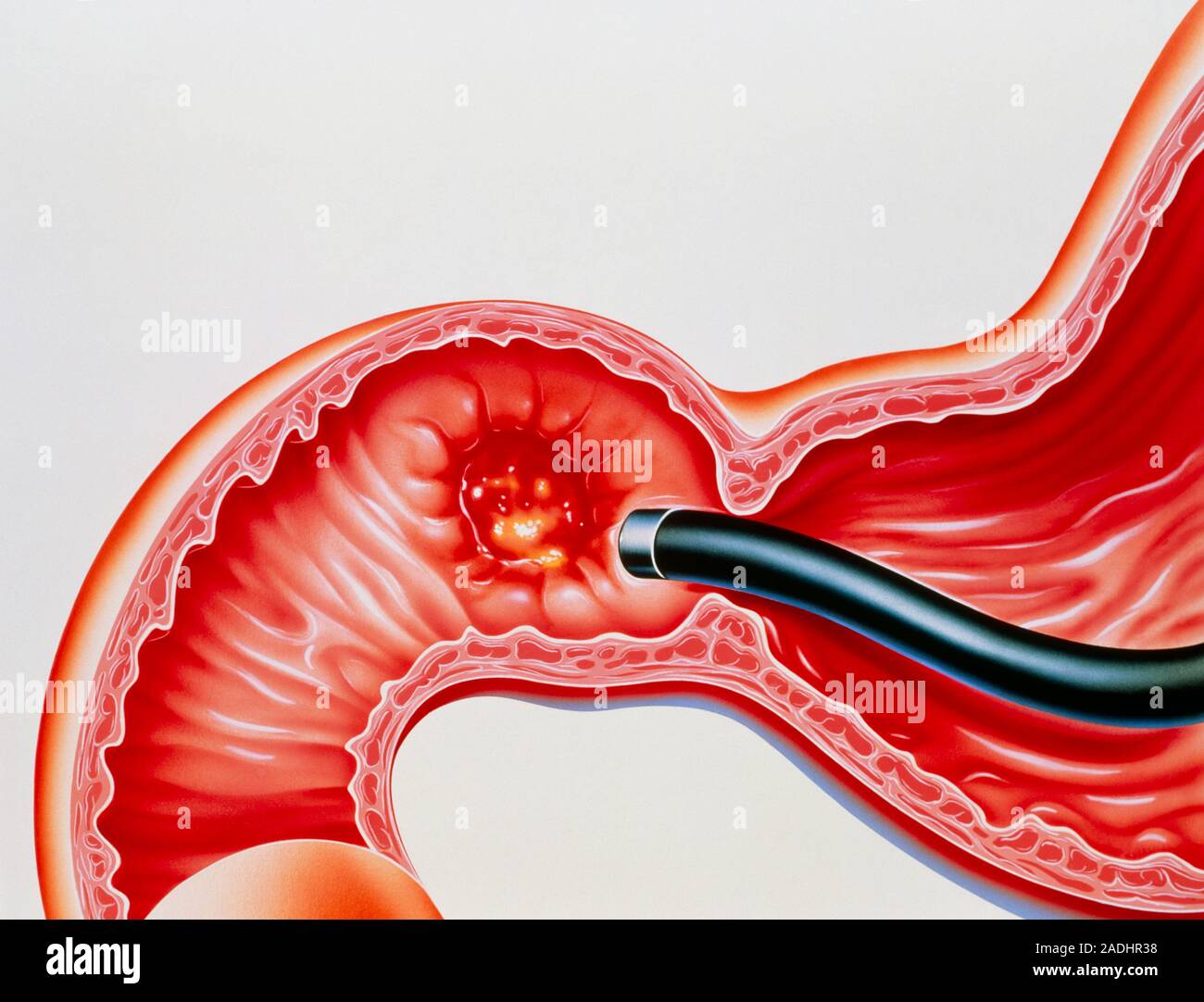 L'ulcère peptique. Illustration d'un ulcère peptique dans le mur de l'humain du duodénum. Le ...
