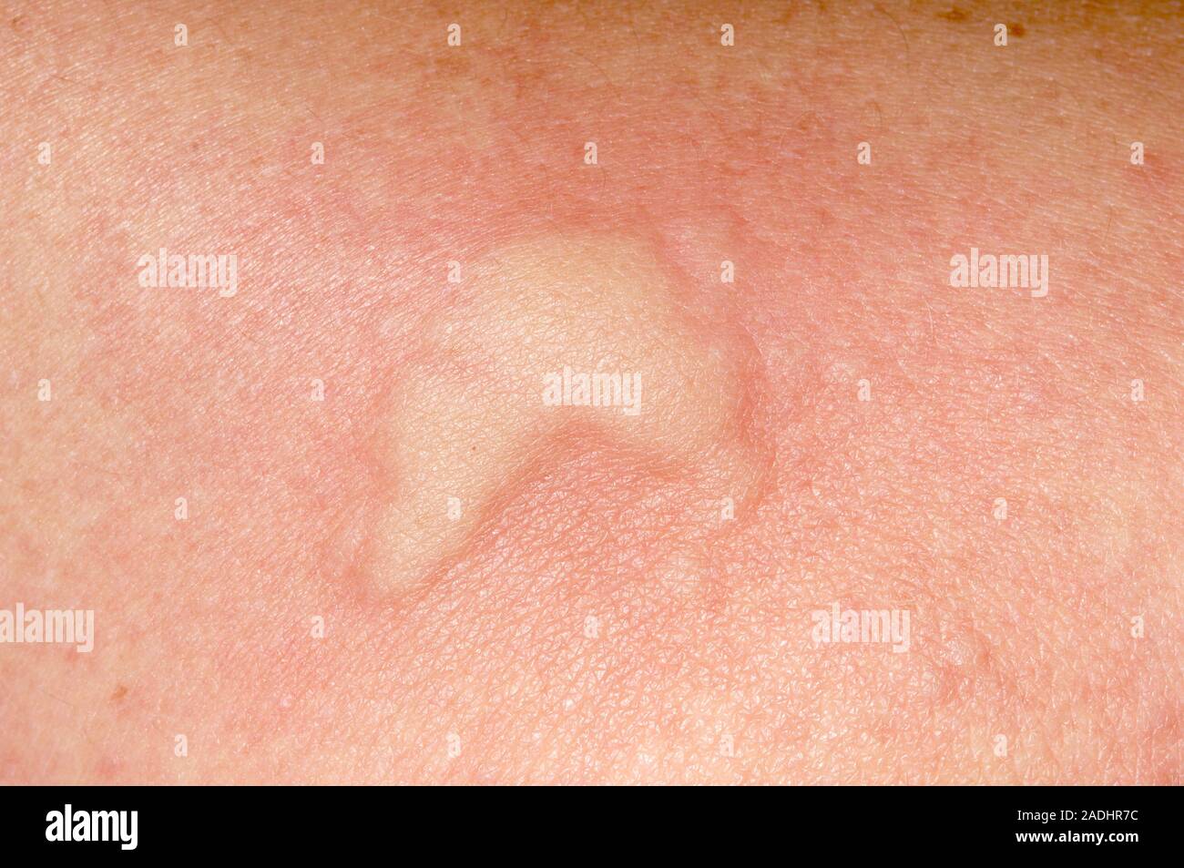 De l'urticaire. Weals sur la peau d'une femme de 32 ans causées par l ...