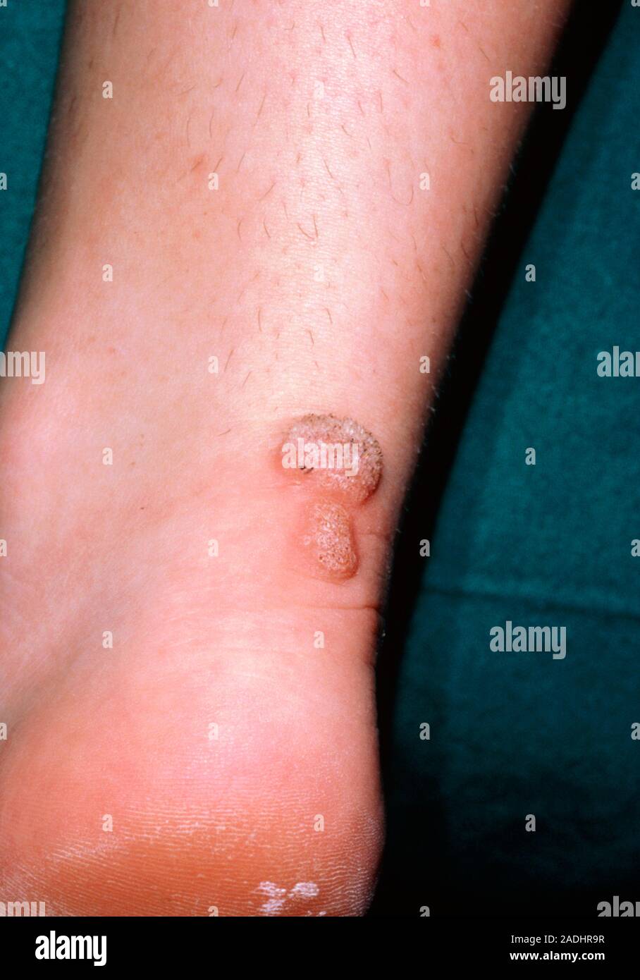 Les verrues sur le talon du pied. Les verrues sont causées par une ...