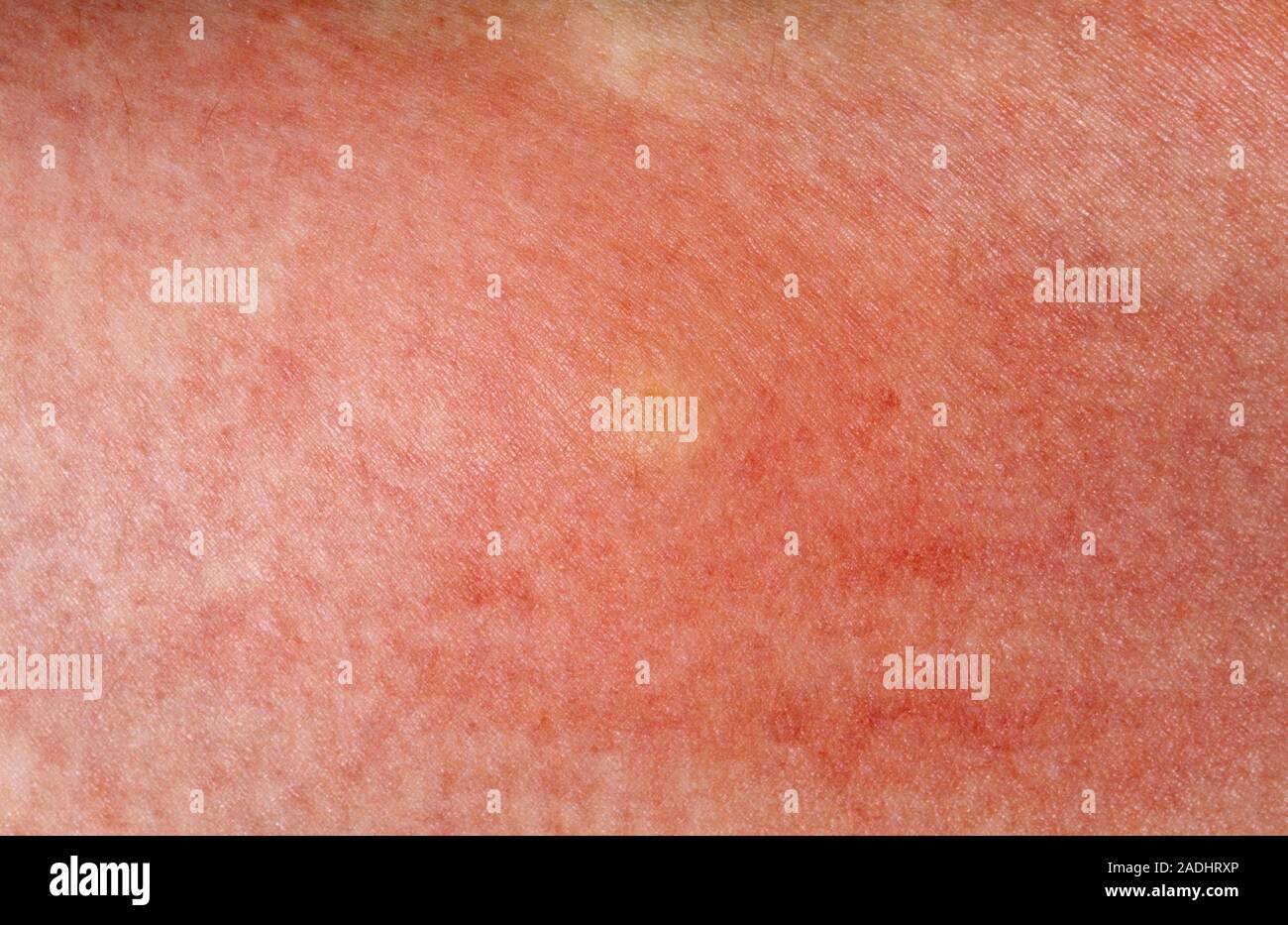 Piqûre d'insecte, jour 2. Image 3 de 3. Patient avec une piqûre d ...