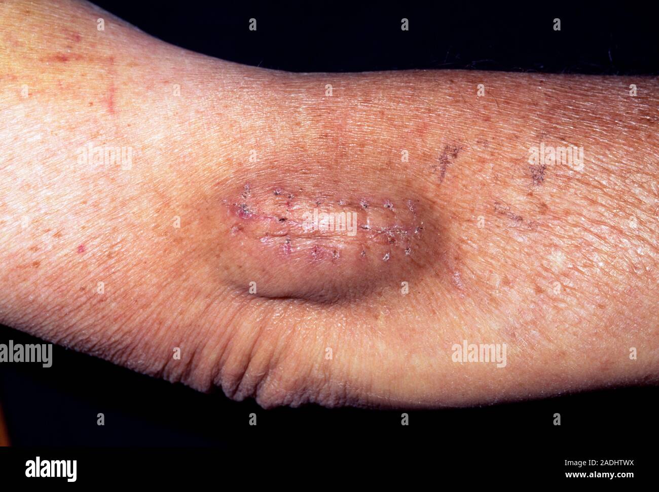 Hémorragie interne post-chirurgicale sur le coude d'un 62-year-old man ...