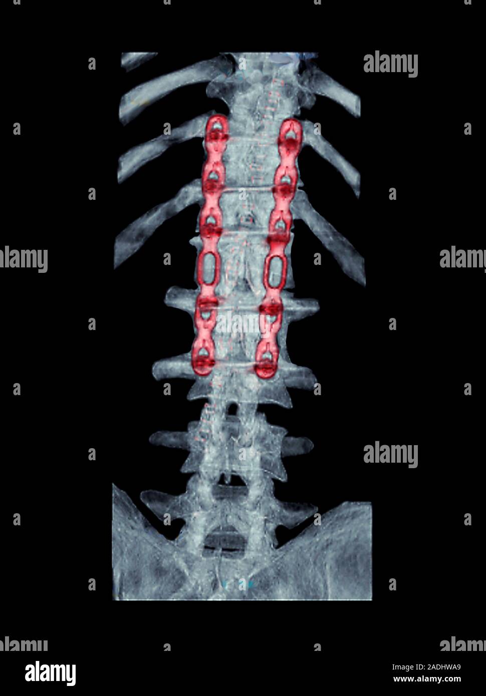 La colonne vertébrale brisée épinglé. Trois dimensions couleur Scanner ...