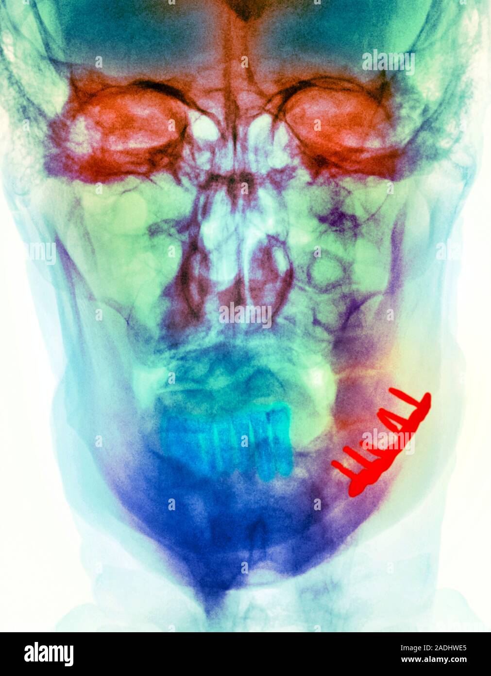 Le tombé sur fracture de la mâchoire. X-ray de couleur du Crâne (vue de ...