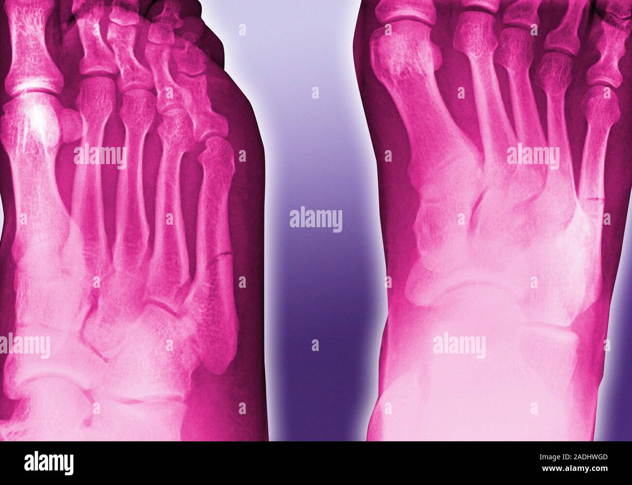 Fracture du pied. Les rayons X de couleur d'une fracture du cinquième ...
