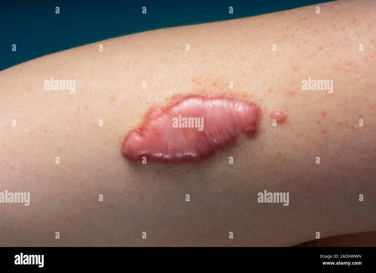 Cicatrices chéloïdes sur la peau du patient. Un est un keloid scar ...