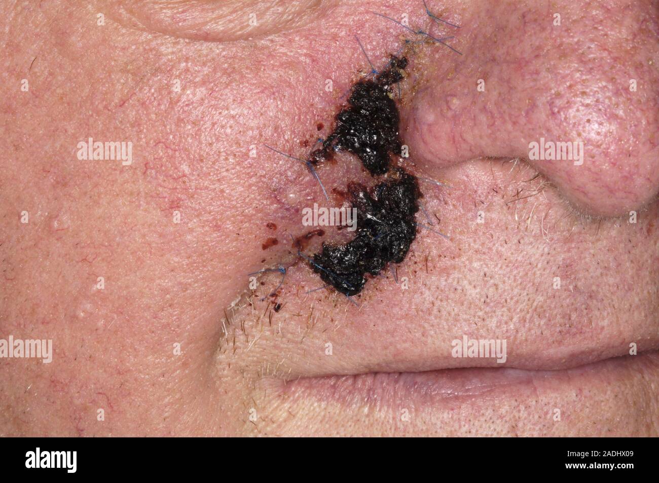 Parution du modèle. Le carcinome basocellulaire de la chirurgie. Image ...