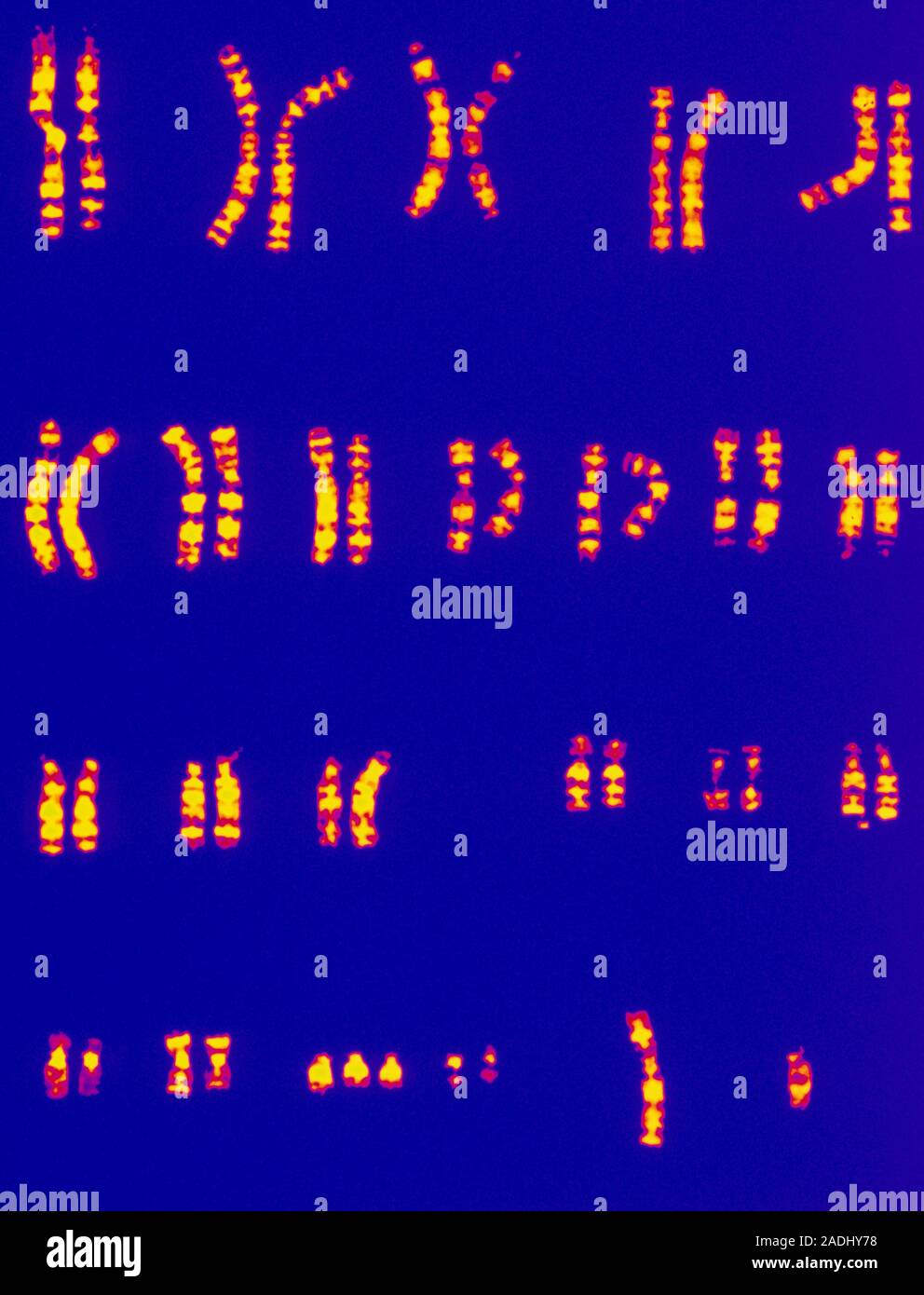 Le syndrome de Down. Caryotype couleur des chromosomes dans un mâle ...
