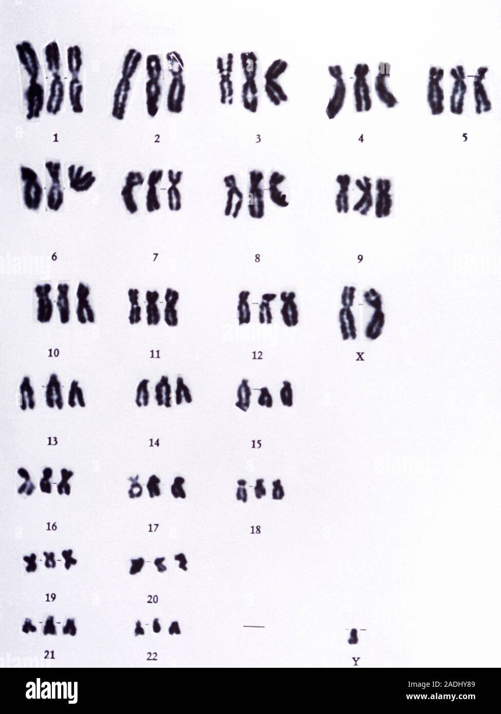 La triploïdie. Caryotype (ensemble de chromosomes) d'une personne avec ...