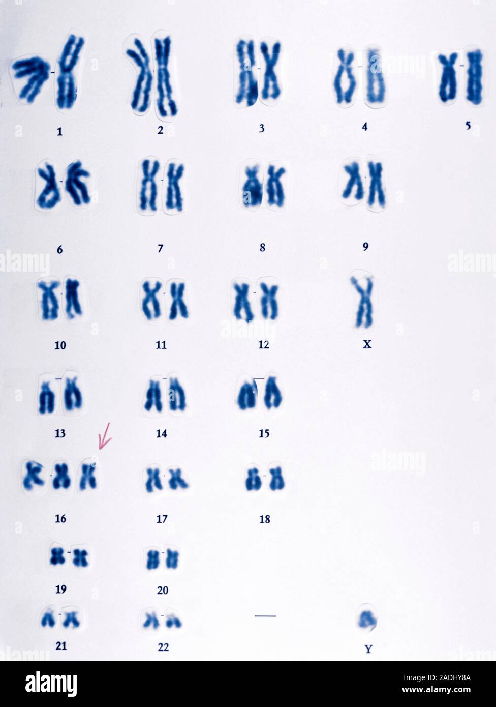 La trisomie 16. Caryotype de chromosomes humains montrant le désordre ...