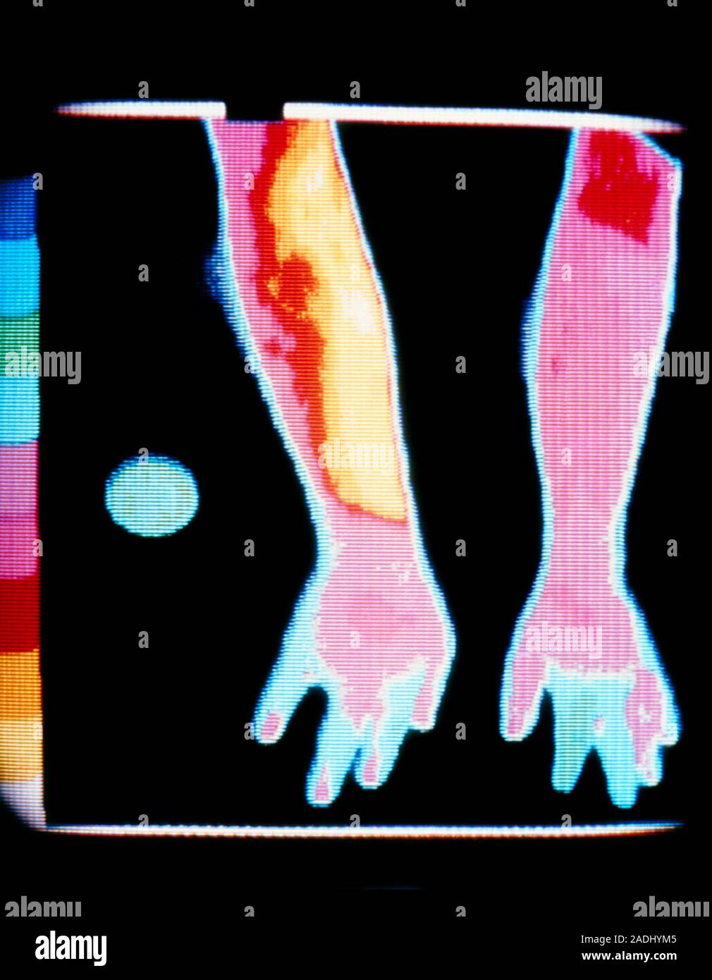 D'un thermogramme personne bras et des mains avant de fumer une ...