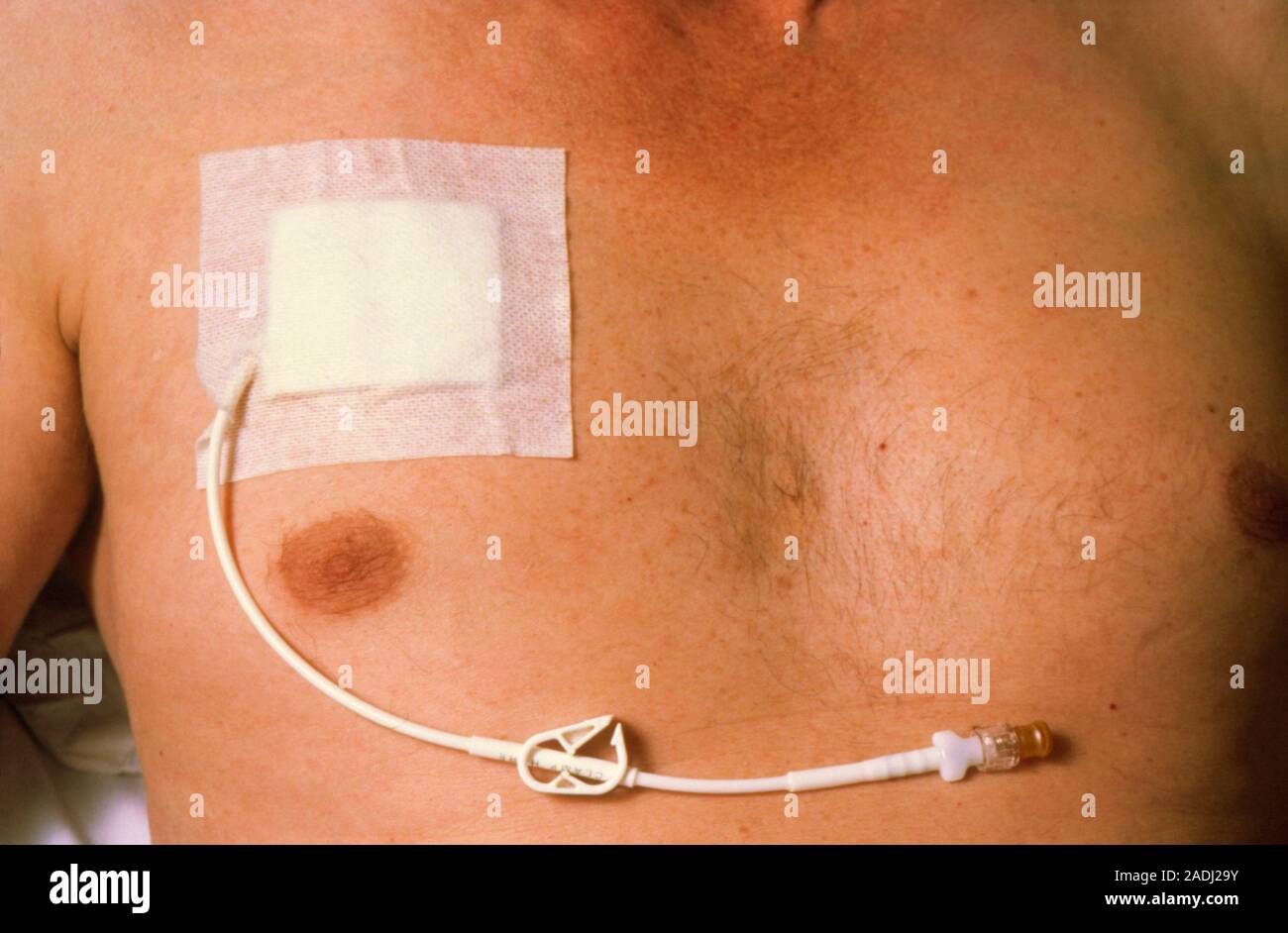 Cathéter de Hickman situés sur un homme de la poitrine du patient. Un ...