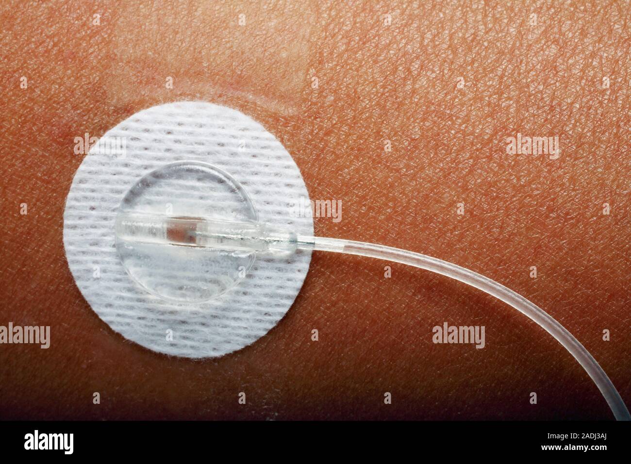 Matériel de perfusion de sang en cours d'utilisation sur une cuisse du ...